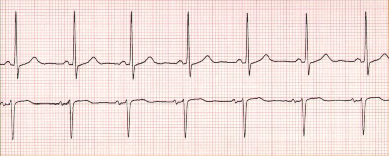 EKG Rhythms Interpretation. Best Practice Quiz Strips ACLS