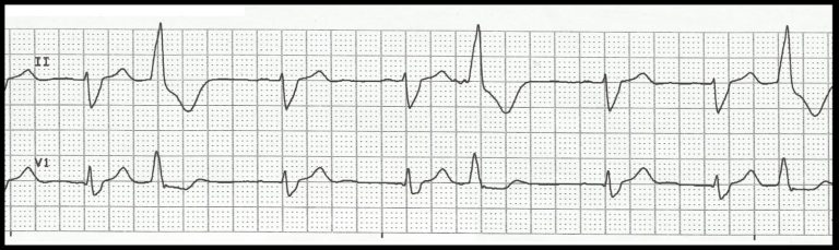 EKG Rhythms Interpretation. Best Practice Quiz Strips ACLS
